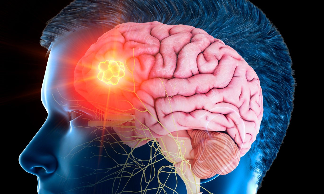 Brain Surgeons Getting A Clearer Picture To Remove Tumors Vitals Brain Surgeons Getting A Clearer Picture To Remove Tumors Vitals